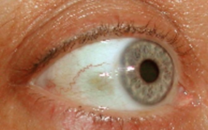 Bubble on Eyeball – Causes and Treatment