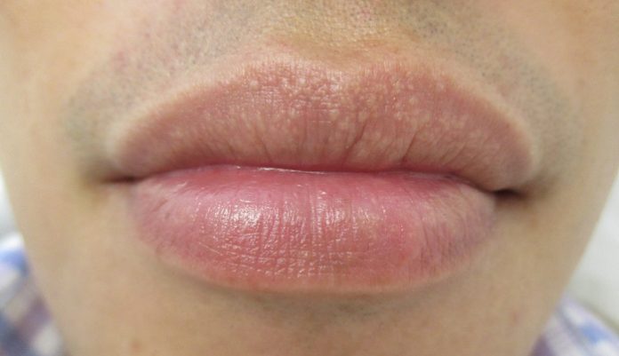Fordyce Spots on Lips and Shaft – Causes and Treatment