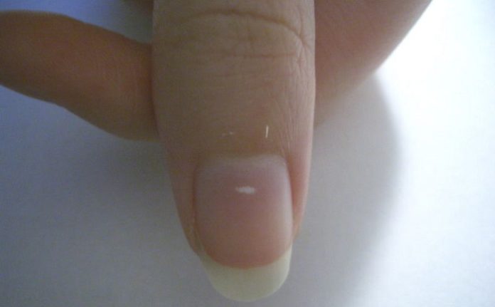 White Spots on Fingernails and Toenails – Causes and Treatment